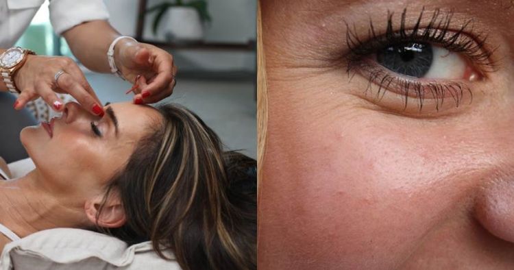 8 Efek perawatan botox yang harus diketahui, tak cuma memar