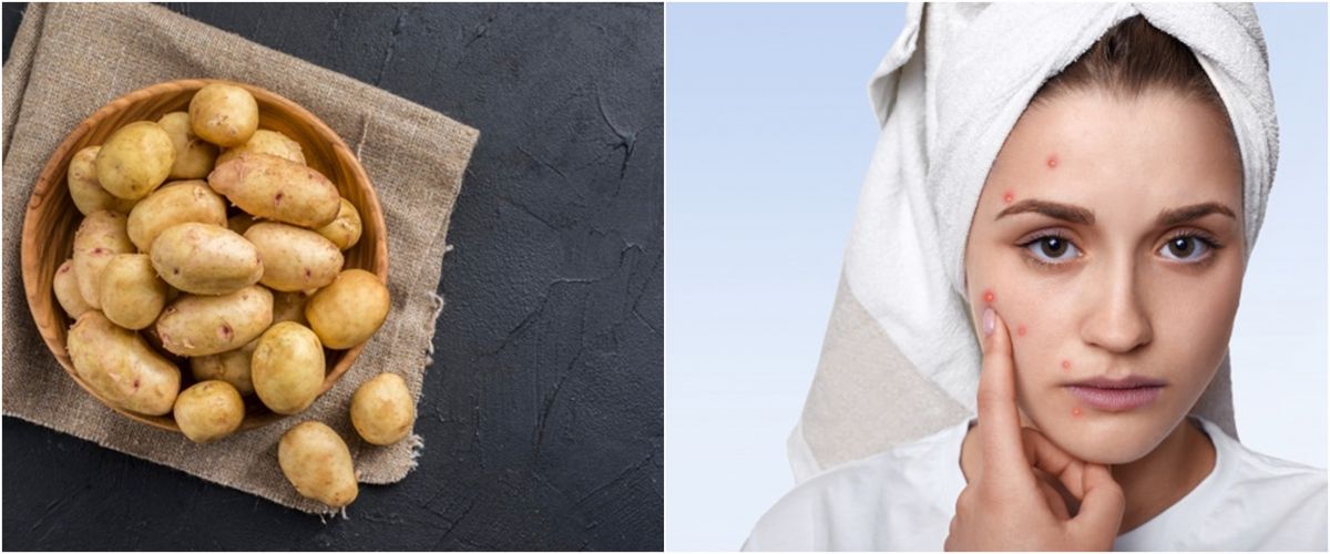 6 Manfaat kentang untuk wajah, bisa mengatasi jerawat