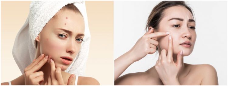 9 Kandungan skincare untuk kulit berjerawat, wajib dicoba