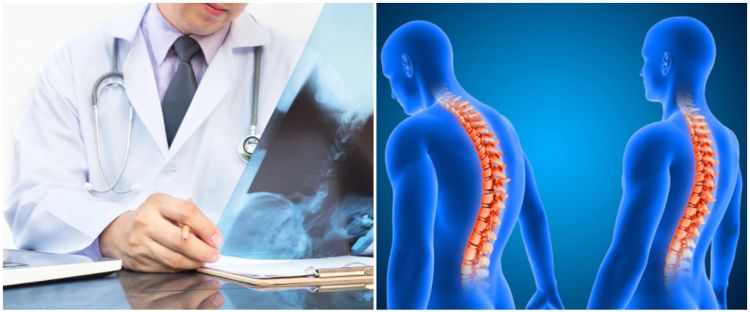 Kifosis adalah kelengkungan pada tulang, kenali gejala dan penyebabnya