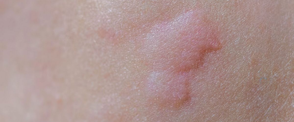 Dijamin ampuh, begini 7 cara mengatasi biduran menggunakan bahan