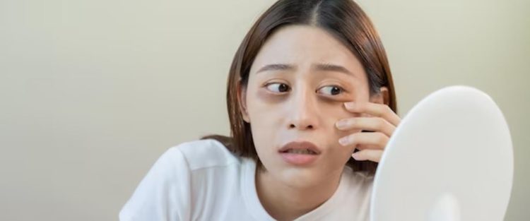 Bantu Hempas Mata Panda Begini Trik Mudah Mencerahkan Under Eye