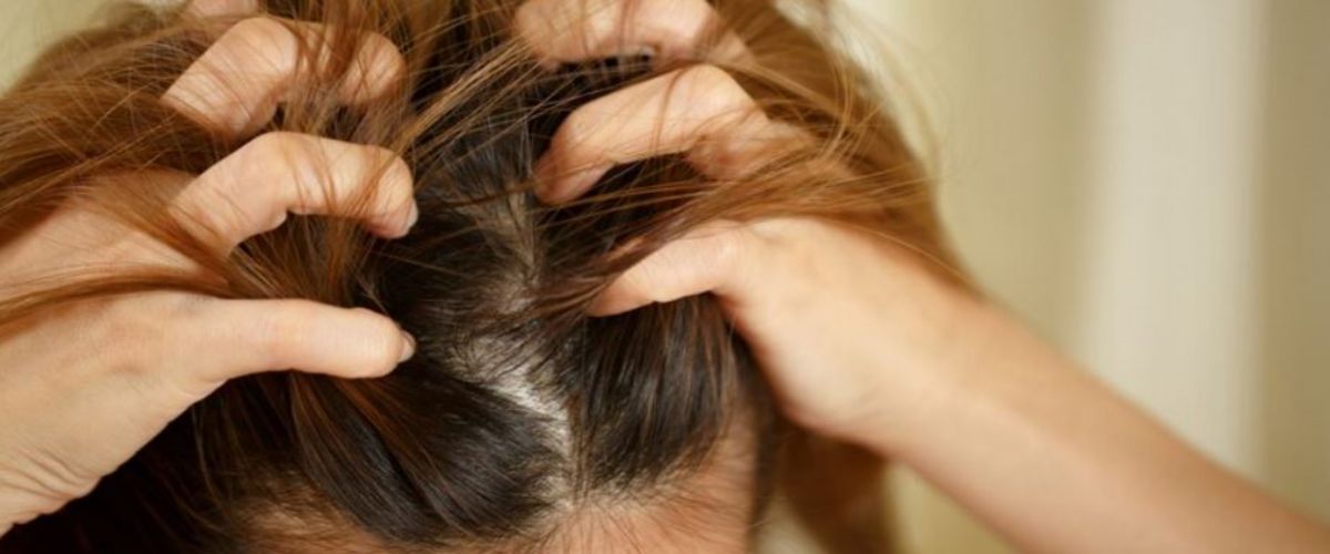 Cara atasi psoriasis pada kulit kepala ini hanya pakai 3 bahan alami ...