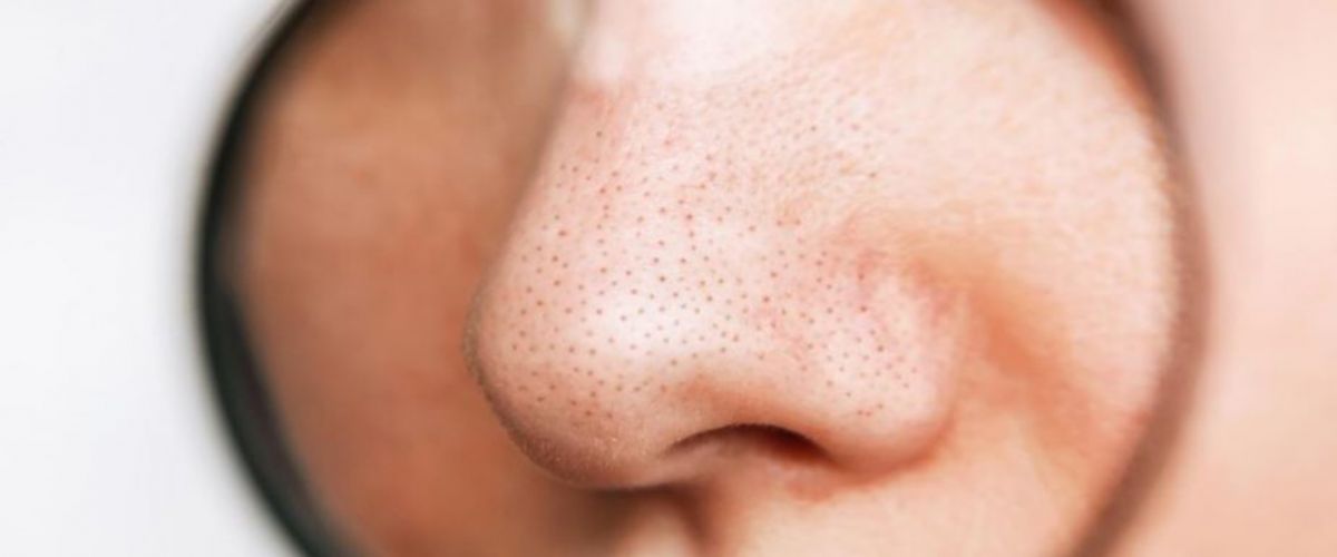 Cuma pakai 4 bahan alami, begini cara menghilangkan komedo dan kulit ...