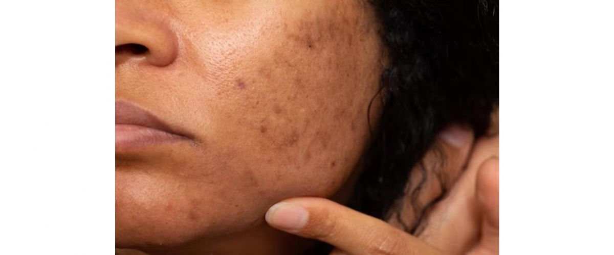 Kulit bebas kucel, begini cara dapatkan wajah tampak sehat dan ...