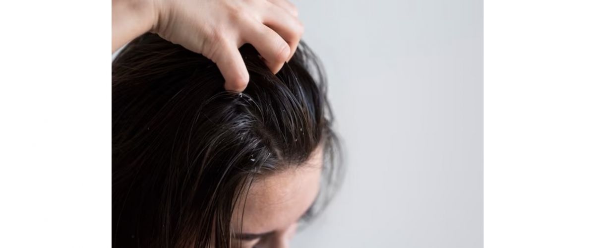 Trik atasi minyak berlebih di kepala pakai 2 jenis bahan makanan,