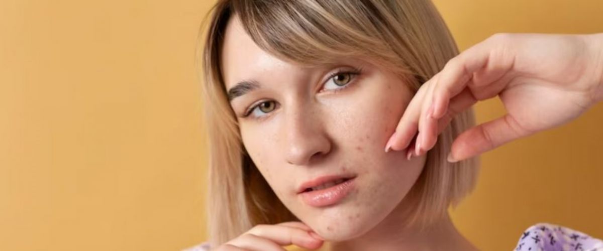 Bukan pakai sheet mask, ini trik menenangkan wajah breakout pakai