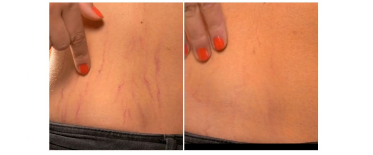 Bukan pakai minyak zaitun, begini cara menyamarkan tampilan stret