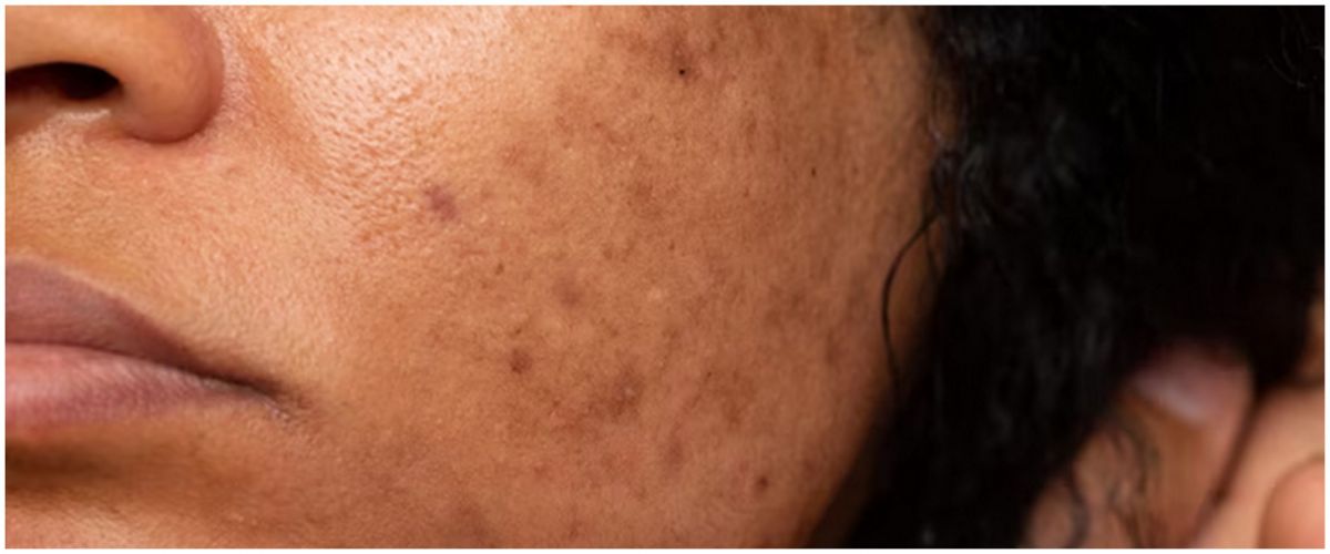 Tanpa laser wajah, ini cara mudah pudarkan flek hitam agar kulit ...