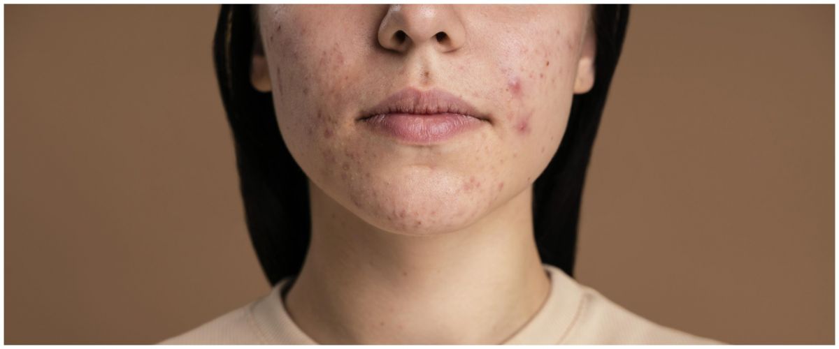 Bukan hanya kunyit, ini trik mudah mencerahkan noda hitam di wajah ...