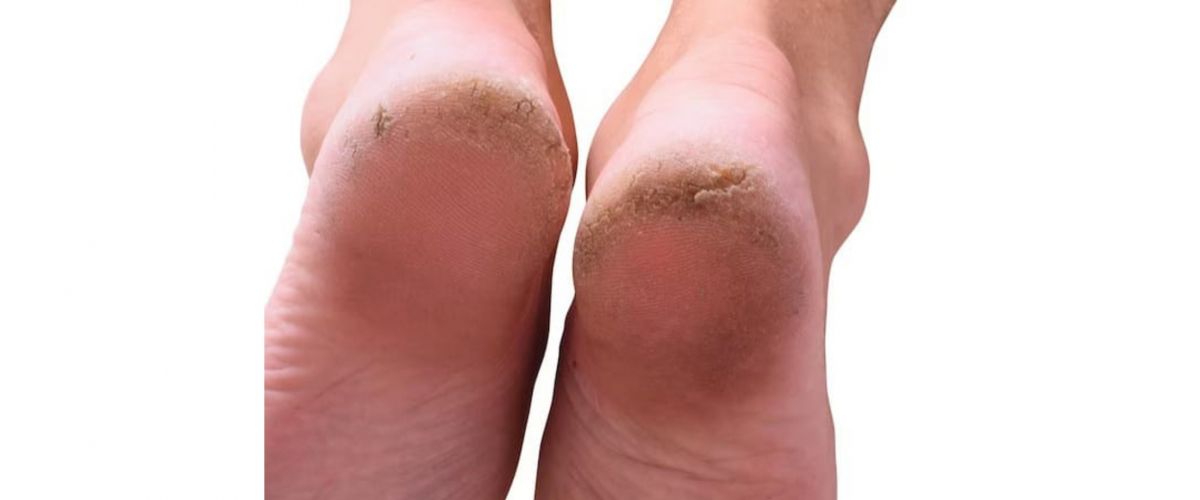 Tak perlu petroleum jelly, ini cara memuluskan telapak kaki retak dan ...