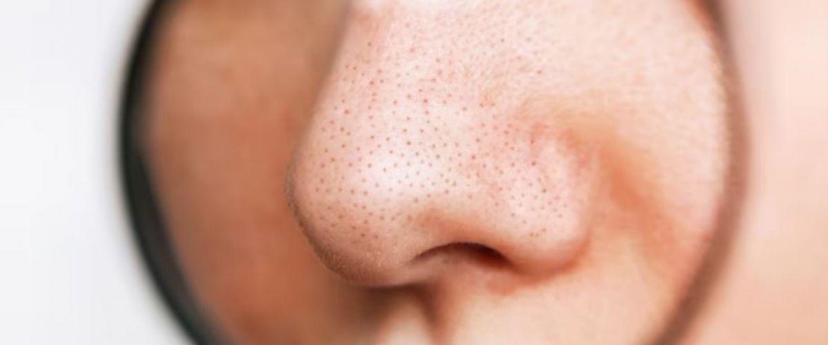 Nggak perlu tambahan lemon, ini trik angkat komedo hitam pada pip