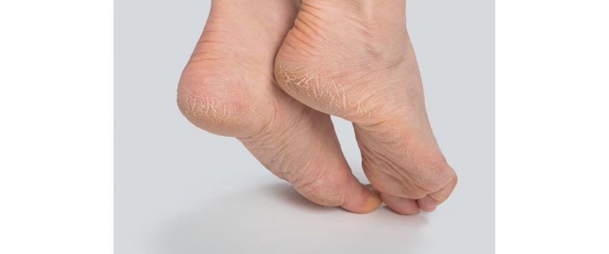 Hasilnya terlihat dalam 3 hari, ini trik lembutkan tumit kaki retak ...