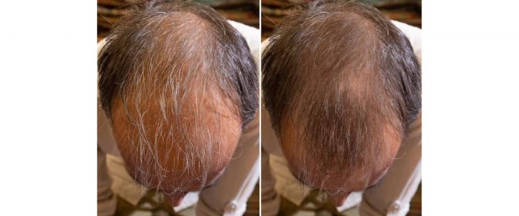 Tanpa kopi atau teh, ini trik menghambat tumbuhnya rambut uban pakai 1 ...