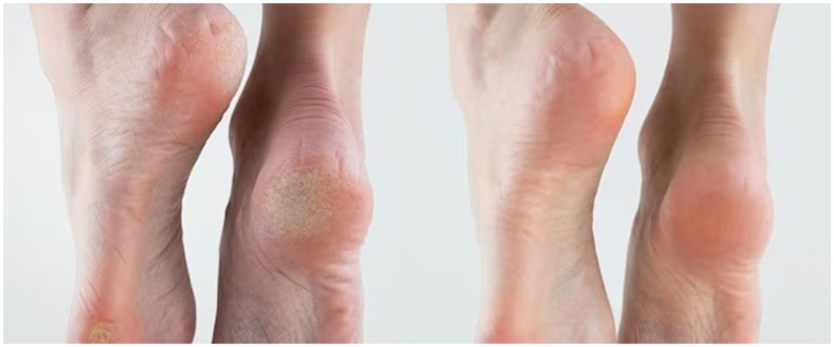 Bukan pakai garam dan petroleum jelly, ini trik atasi tumit kaki retak ...