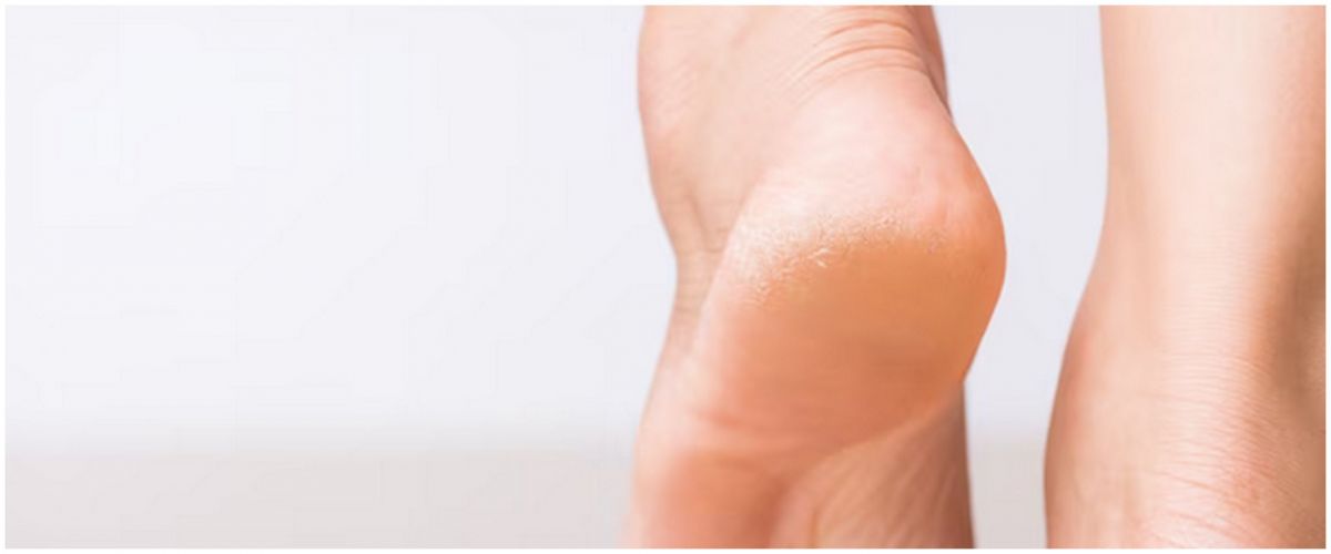 Tak pakai lemon, ini cara rontokan kulit mati penyebab tumit kaki retak ...