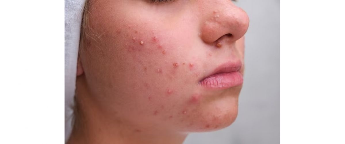 Tanpa produk clay mask, ini trik menghaluskan wajah kasar akibat