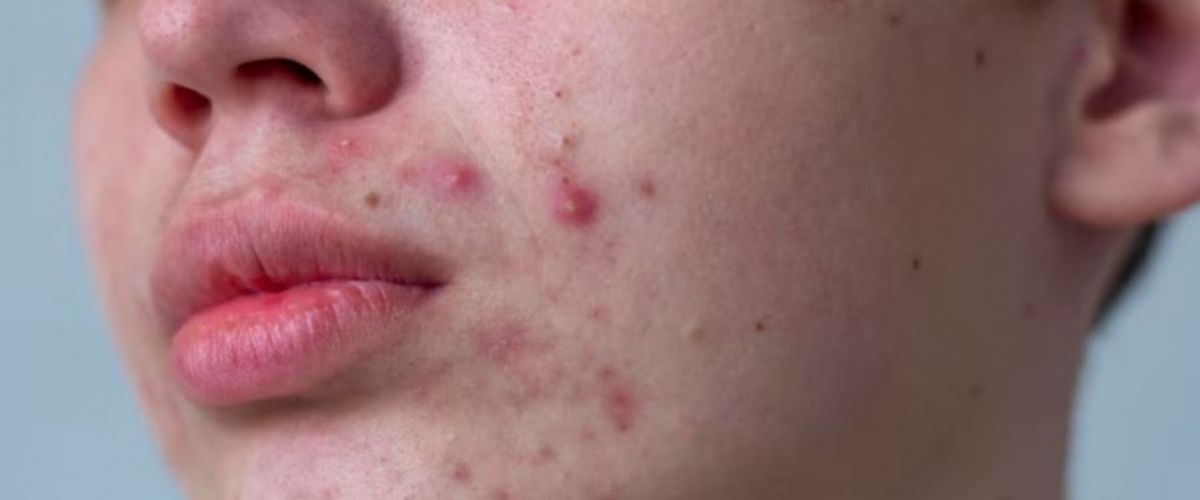 Bukan pakai teh hijau, ini trik atasi jerawat meradang pakai mask