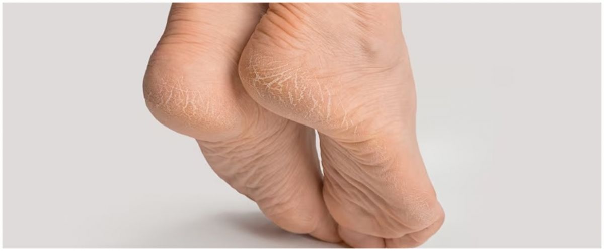 Tanpa gunakan krim wax, ini cara menghaluskan tumit kaki retak dan ...