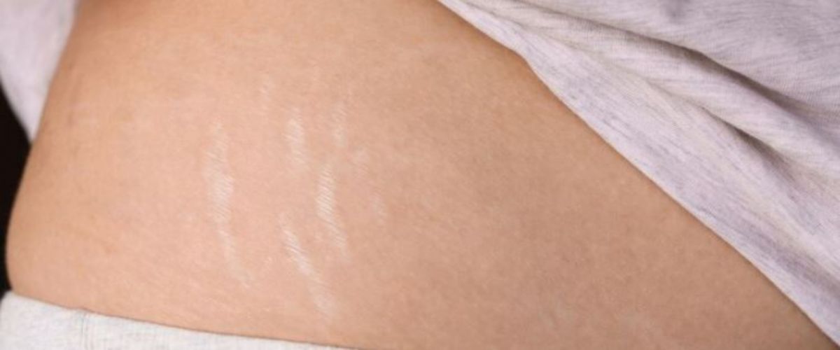 Tak perlu pakai salep, ini trik pudarkan stretch mark membandel pada ...