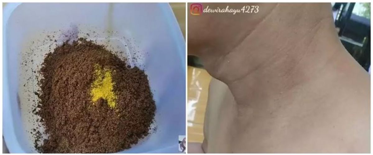 Bikin cerah dan bersih kembali, ini 11 cara atasi leher hitam berdaki ...