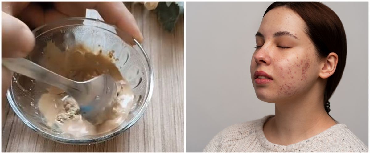 Without acne patches, this beauty vlogger shows how to get rid of acne ...