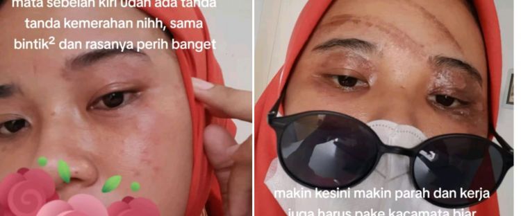 Wanita ini tunjukkan wajahnya usai digigit tomcat sebelum hari ...