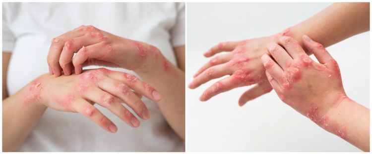 Penyakit scabies yang mudah menular, kenali pengertian, penyebab, dan ...