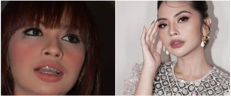 Transformasi 8 penyanyi sebelum dan sesudah pasang behel, bentuk rahang ...