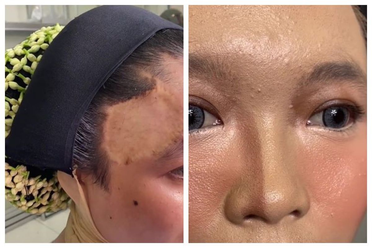 Mottled skin due to surgical scars, this MUA conjures a Javanese bride ...