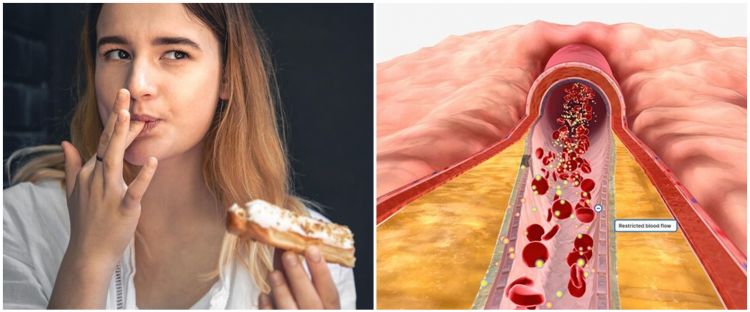 Kadar trigliserida tinggi bisa sebabkan stroke, kenali penyebab, gejala ...