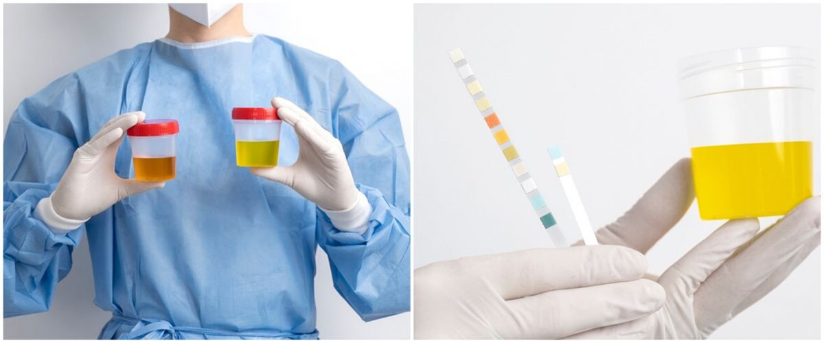 Various colors of urine and their meanings, along with tips for dealing ...