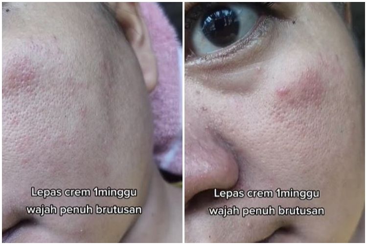 Cewek ini alami penyakit kulit akibat berhenti pakai face cream, wajah ...