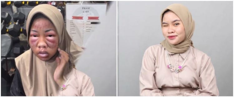 Viral potret cewek berwajah bengkak karena ketimpa barbel 1 kg, begini ...