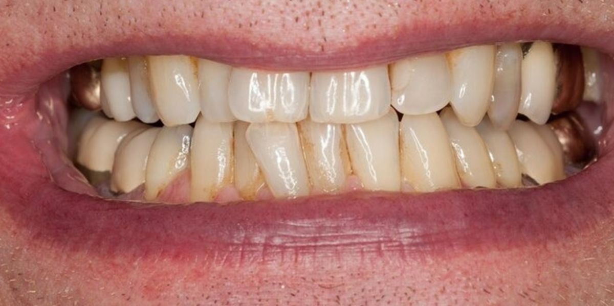 How to remove yellow plaque on teeth without whitening products ...