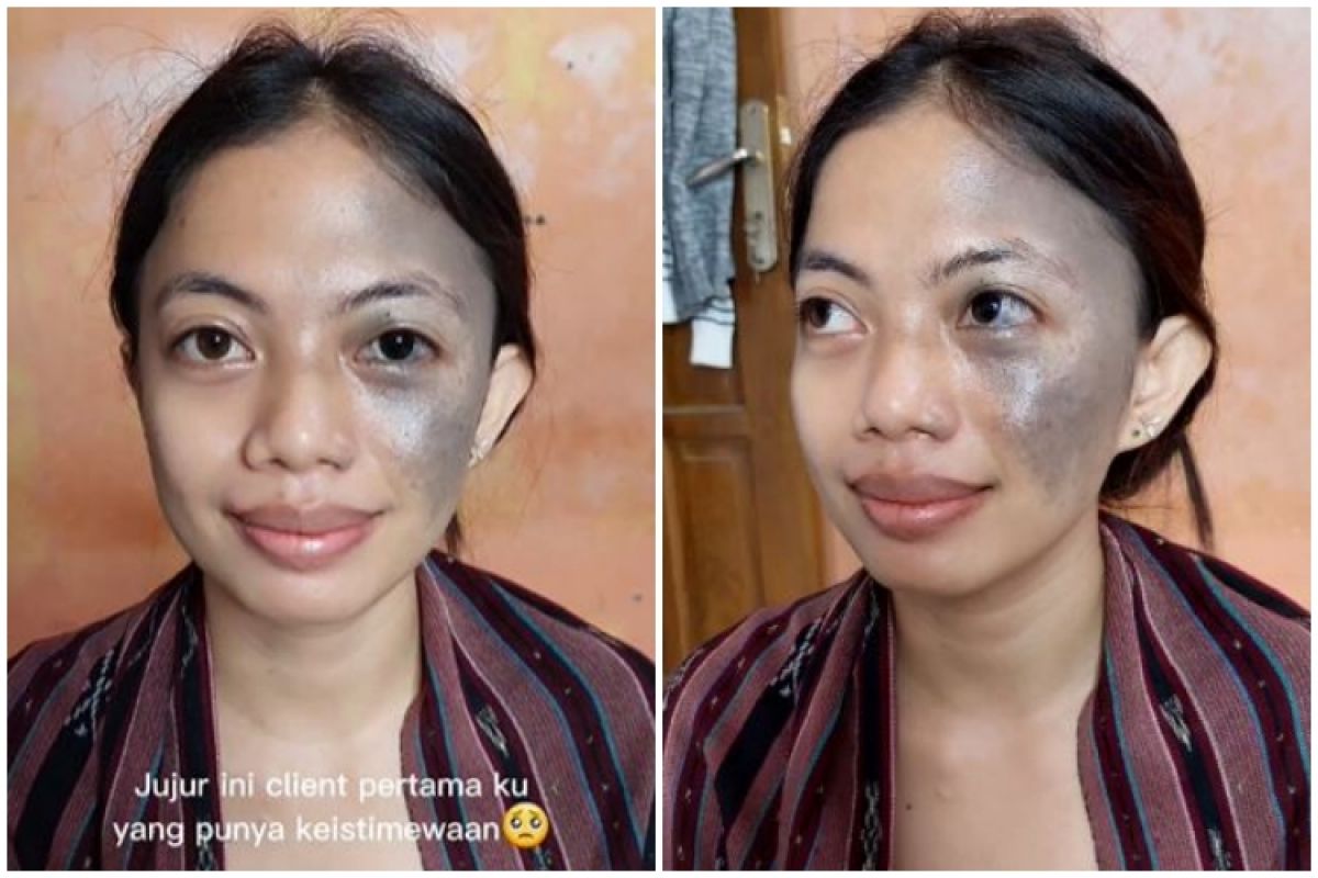 The transformation of a girl with a black birthmark on her face after ...