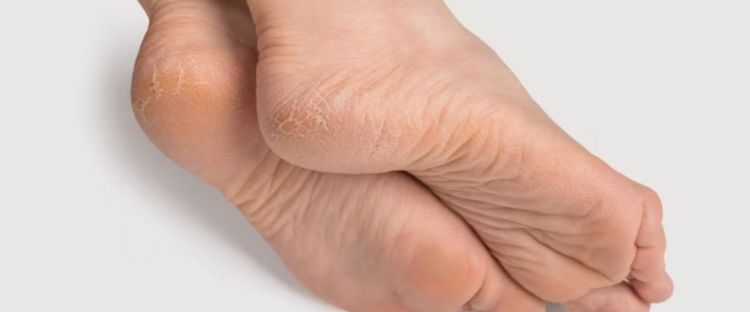 Tak perlu minyak zaitun, ini cara kembalikan tumit retak jadi halus ...