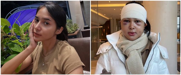 9 Potret Dilan jalani operasi plastik usai diselingkuhi suami, warganet ...