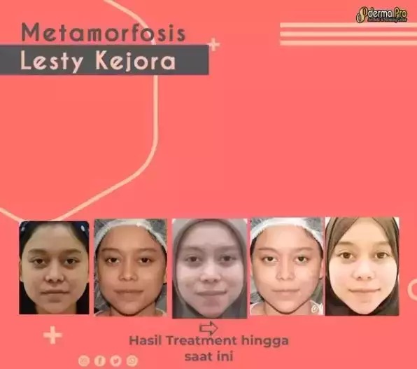 Faces become firmer and don't age, these portraits of 21 celebrities before and after Botox ...