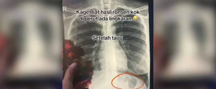 Kaget lihat bentuk aneh di hasil rontgen perutnya, wanita ini malu ...