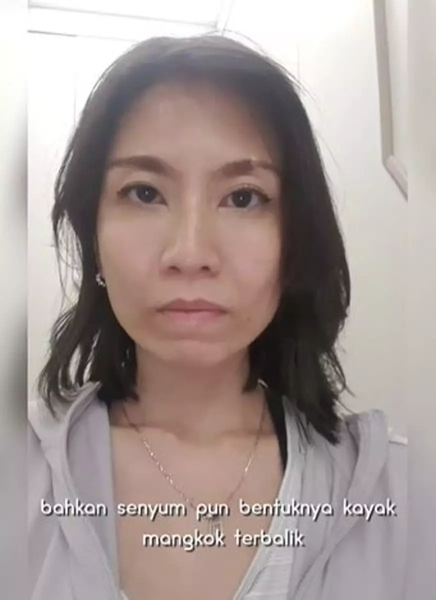 Botox treatment to make her beautiful ended up zonking, this woman's ...